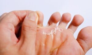Think It’s Just Dry Skin? Tinea Pedis May Be the Real Cause